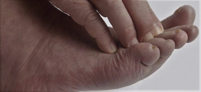 What is Foot Fungus? – Athlete's Foot Fully Explained - Fix Ugly Nails